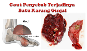 Bicara Mentari: Gout punca batu karang ginjal