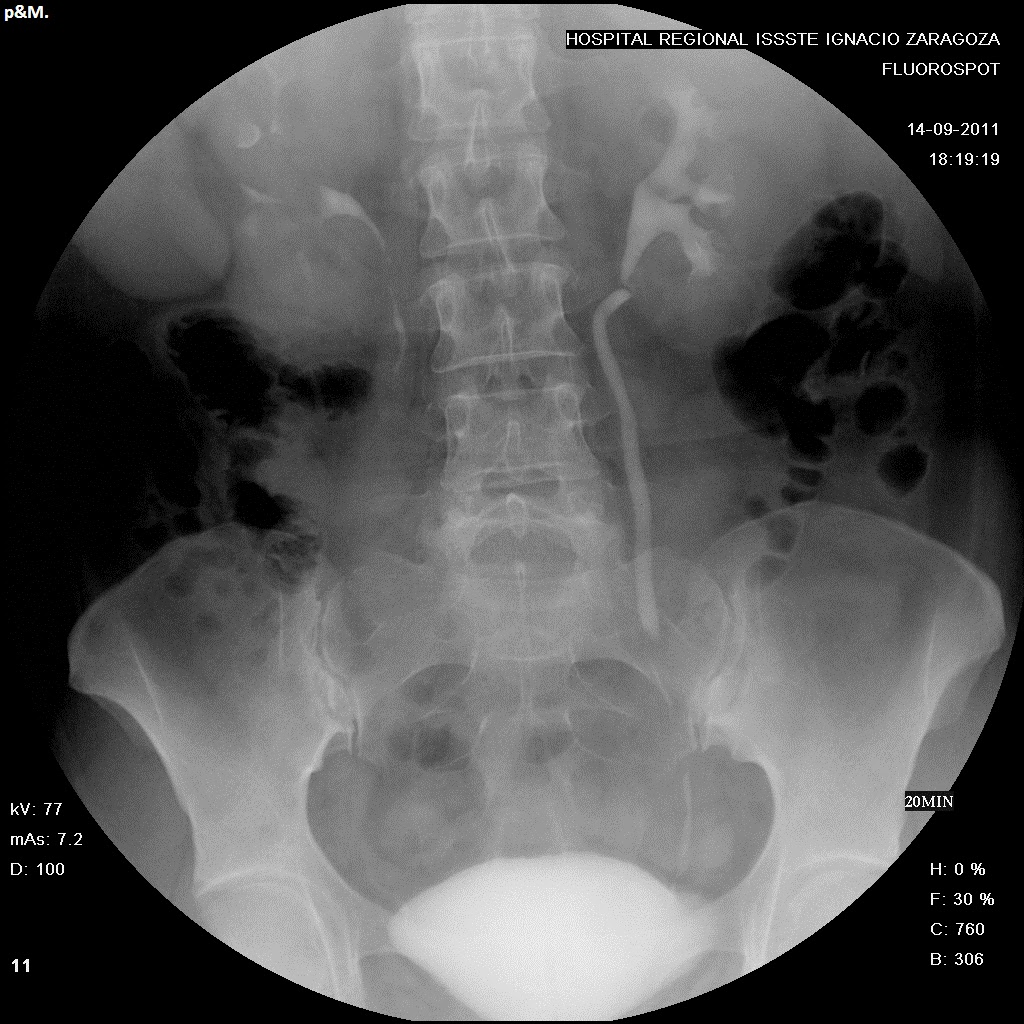 RADIOLOGIA e IMAGEN CETIS 76: UROGRAFIA EXCRETORA