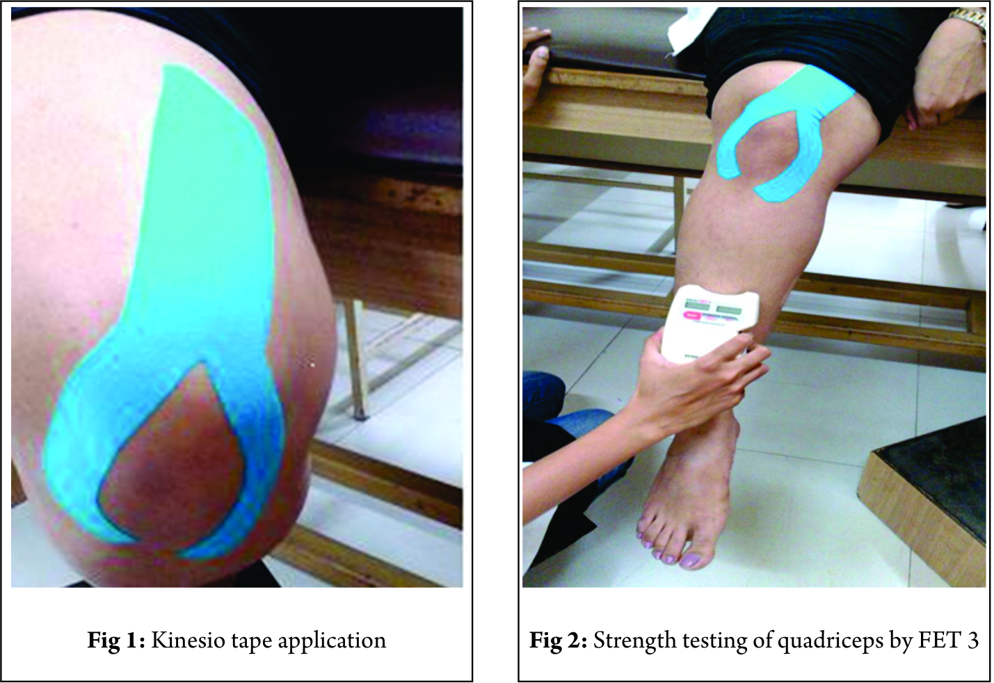 Sports And Community Physiotherapy Kinesio Taping In Knee Osteo