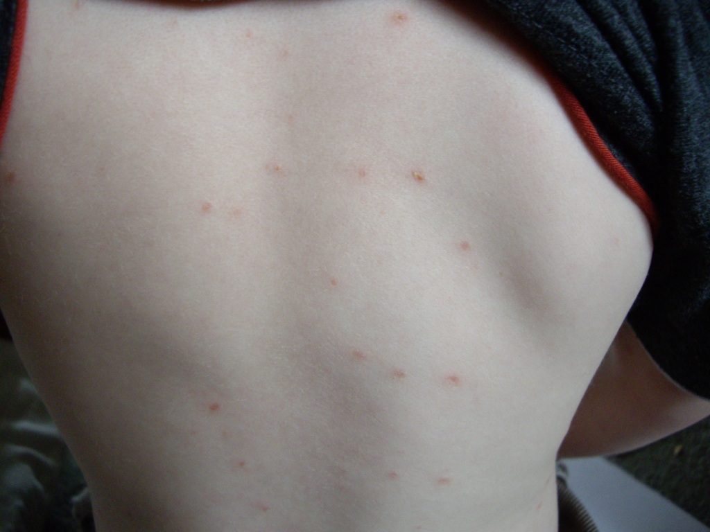 Chicken Pox Rash Day 1 Chicken Pox Rash Day 1