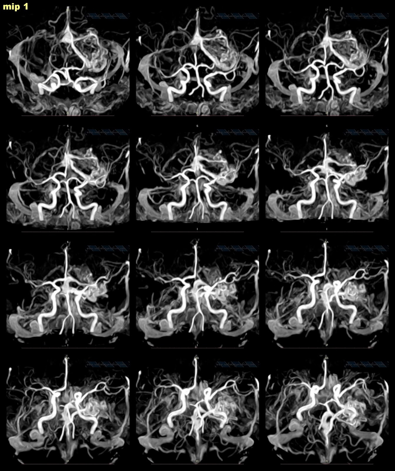 Radiology Archives: Αρτηριοφλεβώδης Δυσπλασία Εγκεφάλου (Spetzler ...