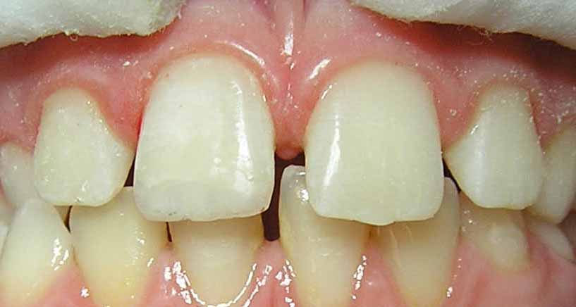 Una Boca para toda la Vida: Traumatismo en niño de 7 años: FRACTURA ...