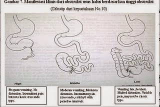 Obat Herbal Illeus Alami dan Aman | Pengobatan Alternatif, Herbal Alami ...