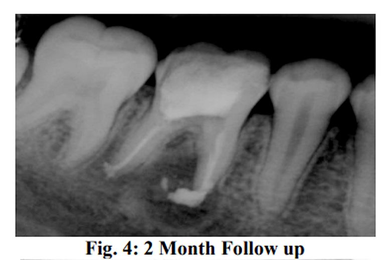 PDF: Non-surgical management of a periapical abscess in a adolescent ...