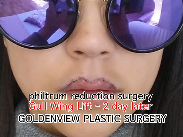 Goldenview Plastic surgery: Lip lift , Lip plastic surgery - phiptrum ...