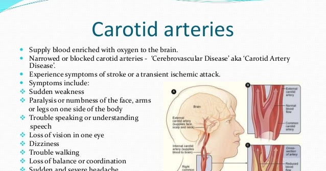 Health Screening for Stroke/Carotid Artery Disease