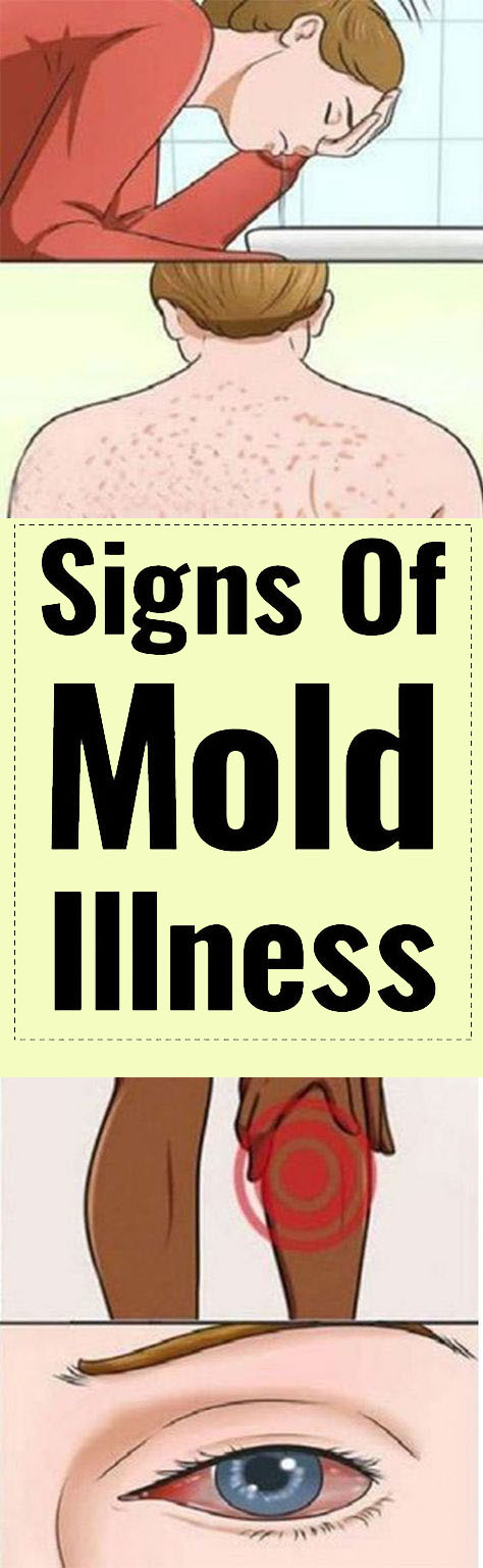17 Signs of Mold Illness (and How to Tell If You Are at Risk) | Health Pins