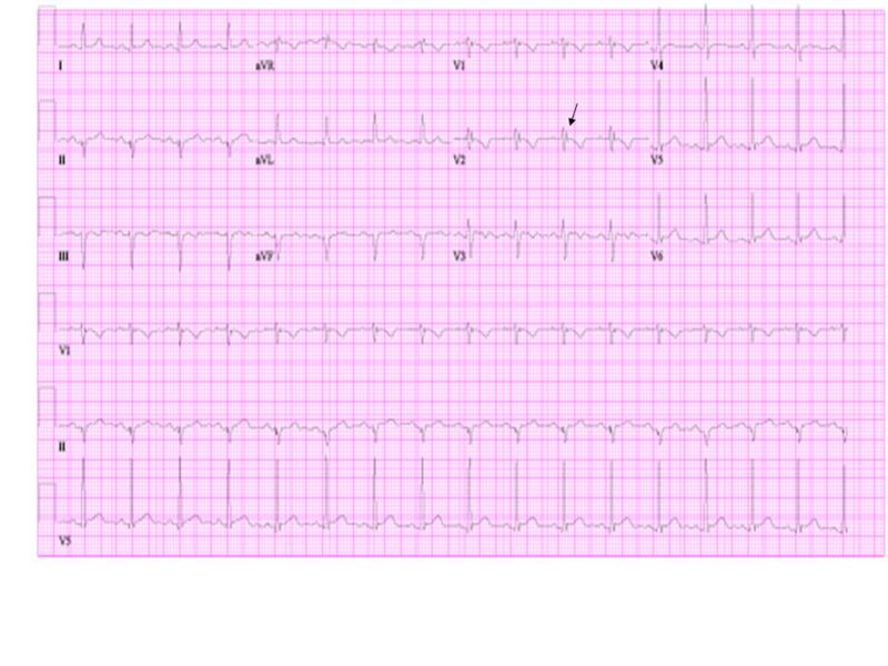 Absorb Medicine: Epsilon Waves in Arrhythmogenic Right Ventricular ...