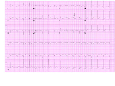 Absorb Medicine: Epsilon Waves in Arrhythmogenic Right Ventricular ...