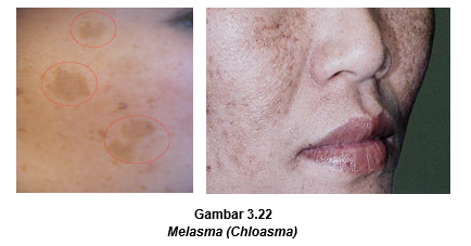 Faktor Penentu Warna Kulit, Fungsi Melanin, Kelainan pada Proses Pembentukan Pigmen Melanin ...