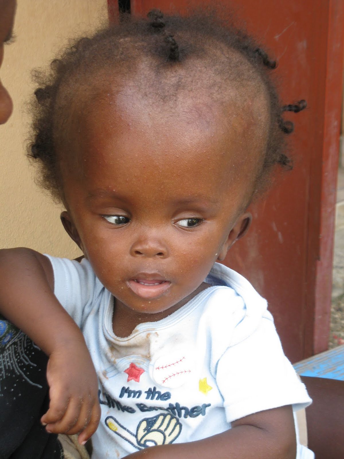 HAITI - CORAM DEO: photos - hydrocephalus - part 1