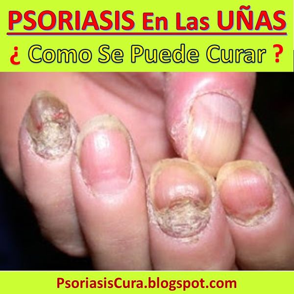 Psoriasis Cura: ᐅ La Psoriasis en las UÑAS o Ungueal 【Tratamientos 2019】
