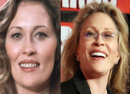 Faye Dunaway Plastic Surgery Facelift, Botox Injections Before and ...