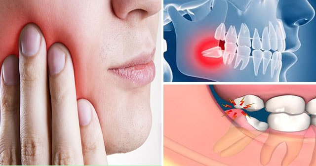 Narito ang 9 na Panlunas sa Kumikirot o Masakit na Wisdom Tooth o ...