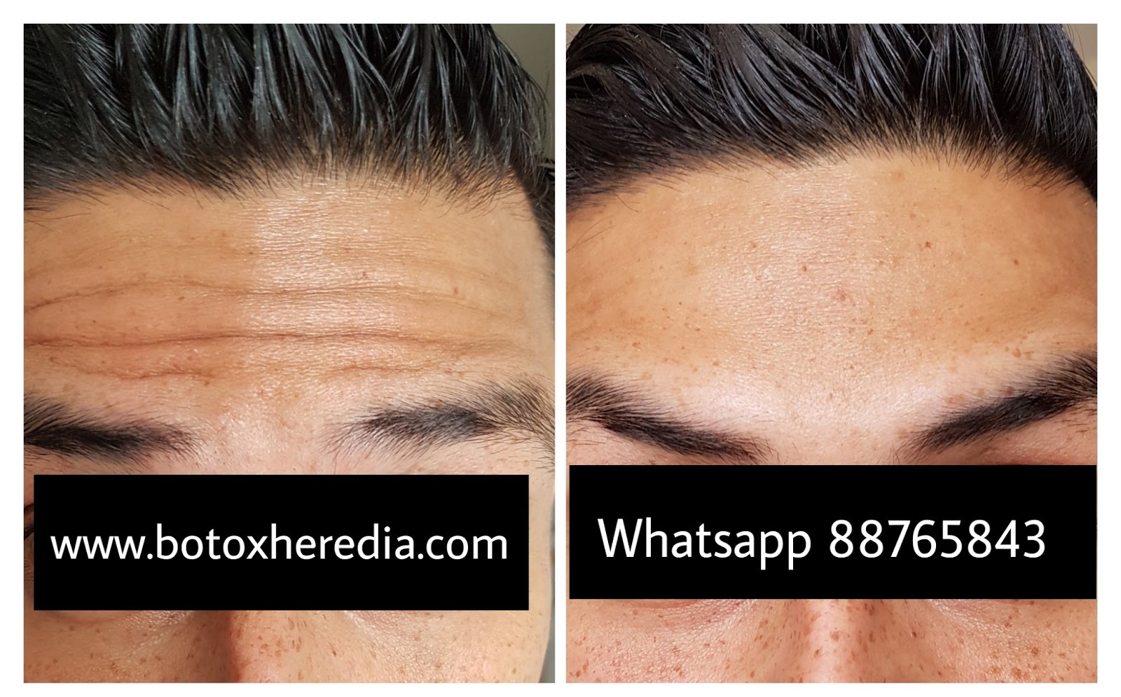 Botox, Acido Hialurónico, Bichectomia, Invisible Touch Hilos Pdo