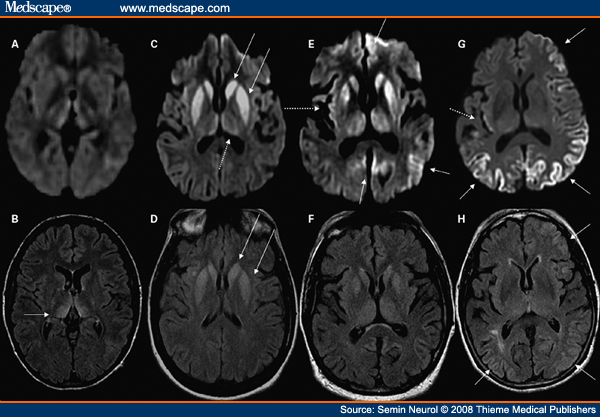 Brain Interactive: 퇴행성 뇌질환 - 2. CJD(Creutzfeldt-Jakob Disease)’s Diagnosis