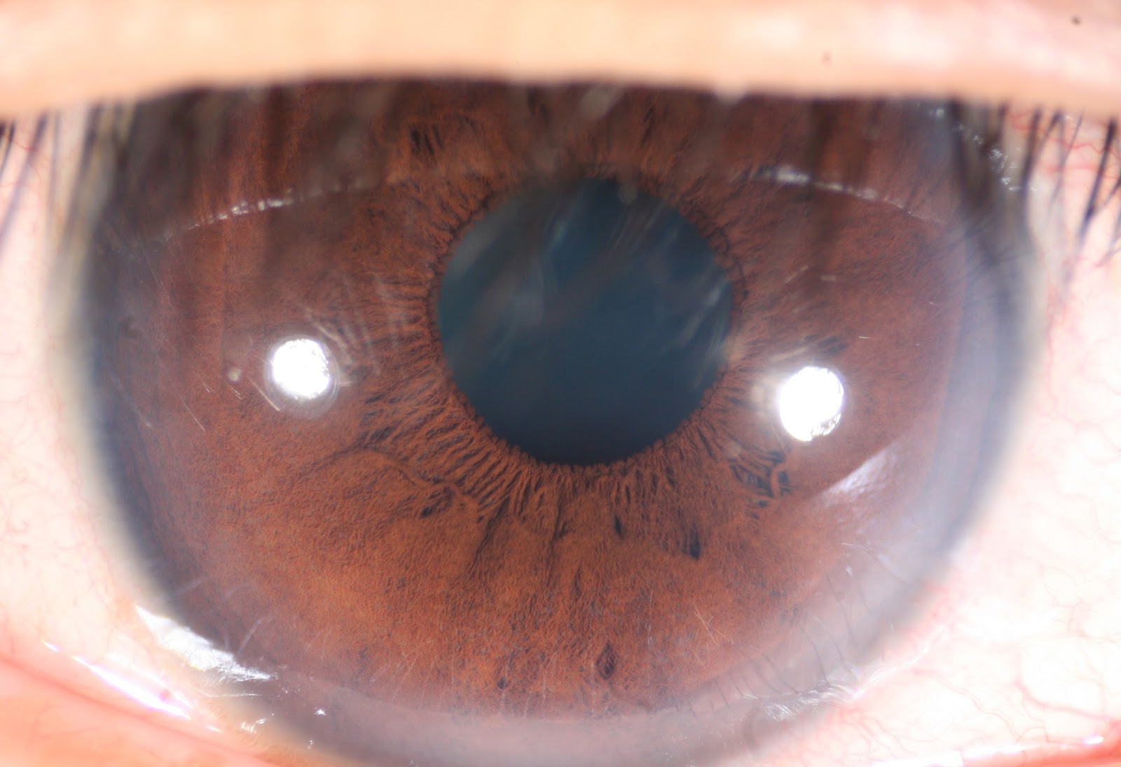 Modern & Multidimensional Iridology: Iris Signs at IPB, Pupillary Zone ...