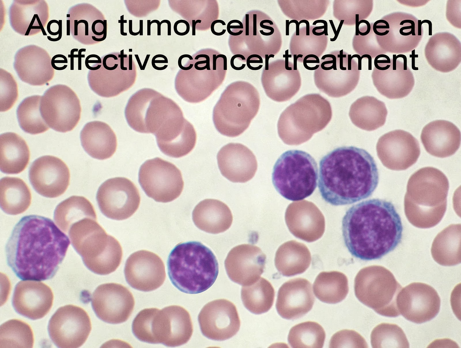 Medical Laboratory and Biomedical Science: Aging tumor cells may be an ...