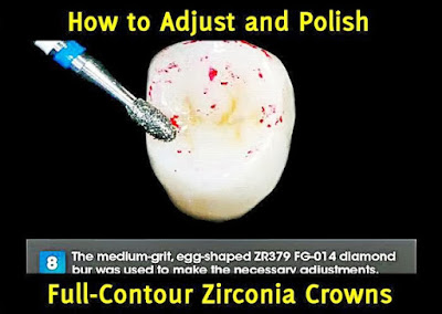 ZIRCONIA CROWNS: How to Adjust and Polish Full-Contour