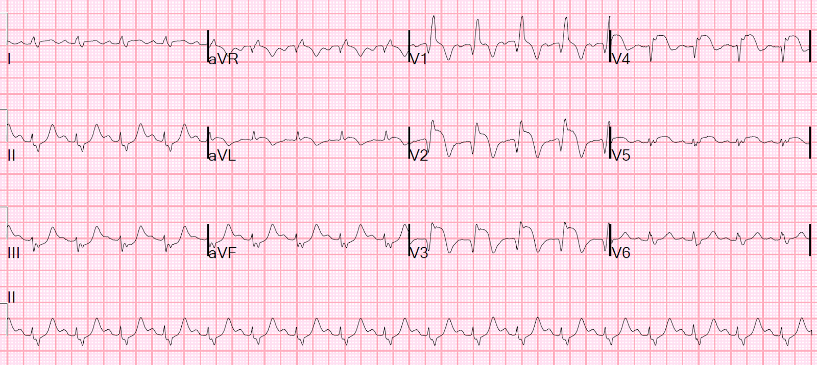 Dr. Smith's ECG Blog: What, besides large anterior STEMI, is so ominous ...