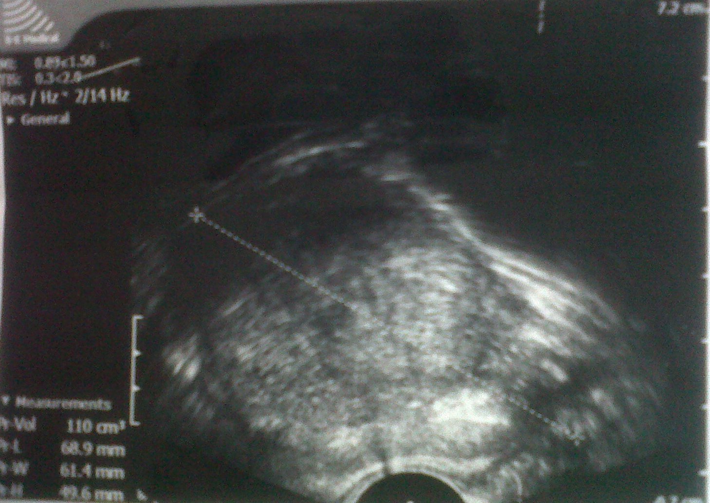 BEDAH UMUM FKUI: BENIGN PROSTATE HYPERPLASIA