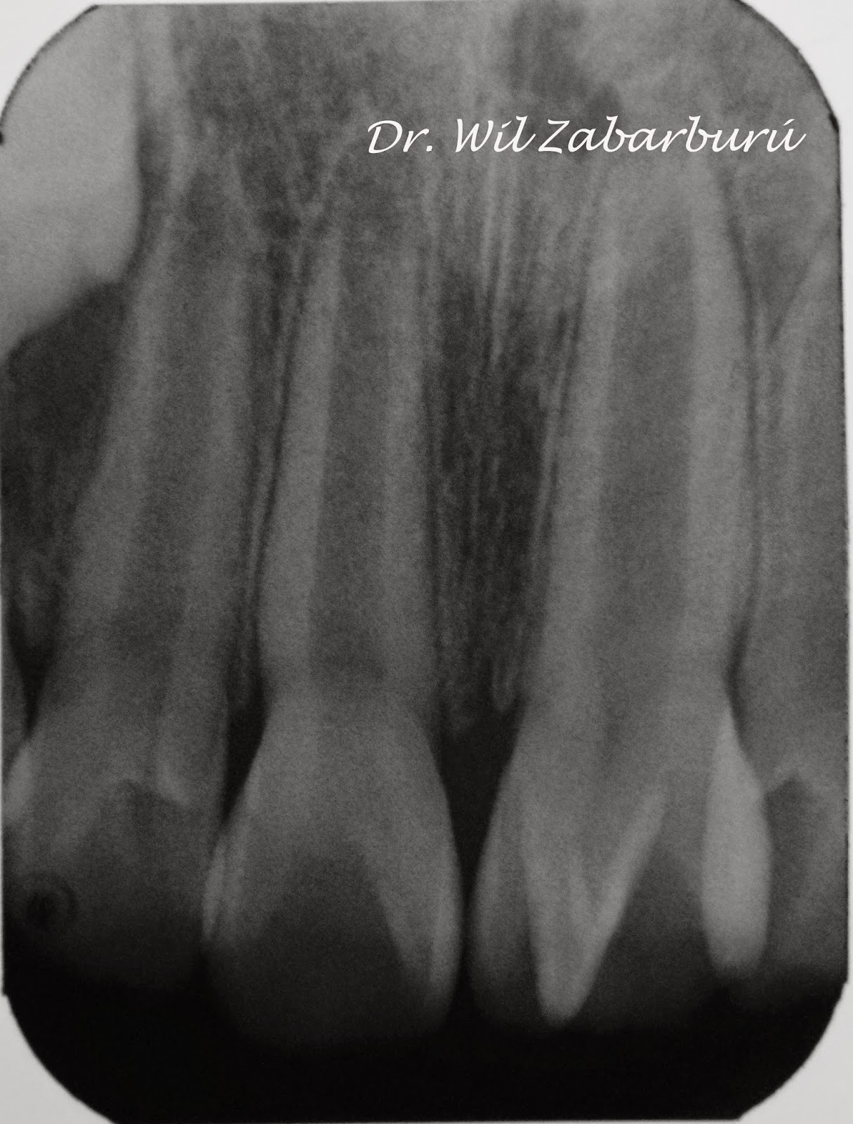 CLINICA DENTAL ASISTENCIAL: TALÓN CUSPÍDEO