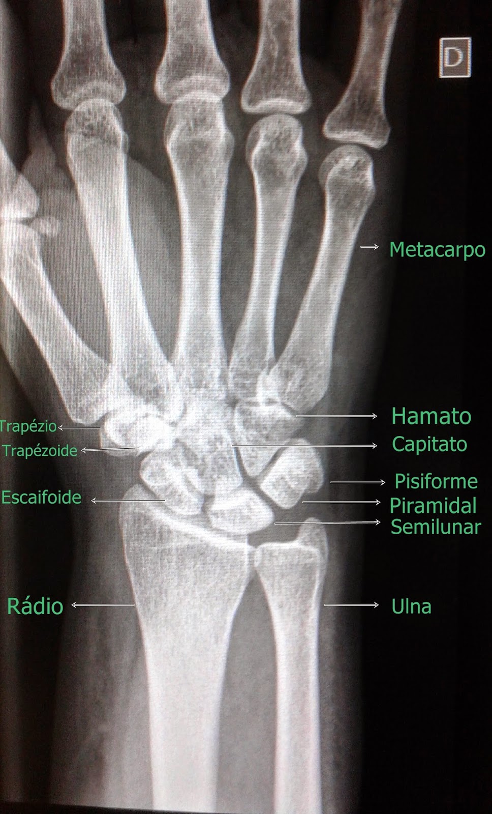DICAS DE RADIOLOGIA: TÉCNICAS RADIOLÓGICAS - MEMBROS SUPERIORES - PUNHO PA