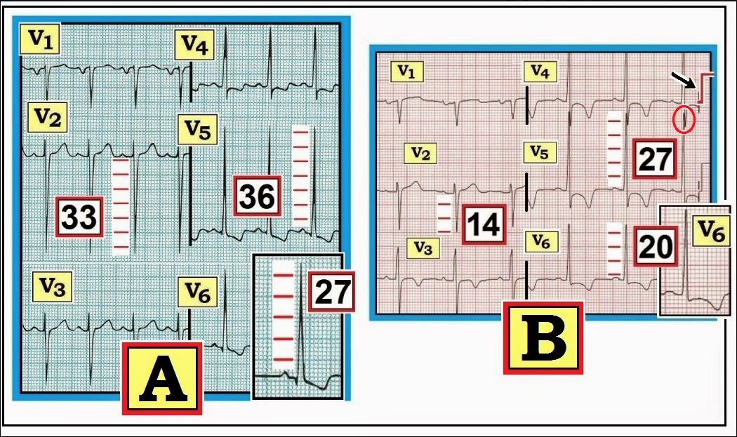 ECG Interpretation: ECG Interpretation Review #73 (LVH – Hypertrophy ...