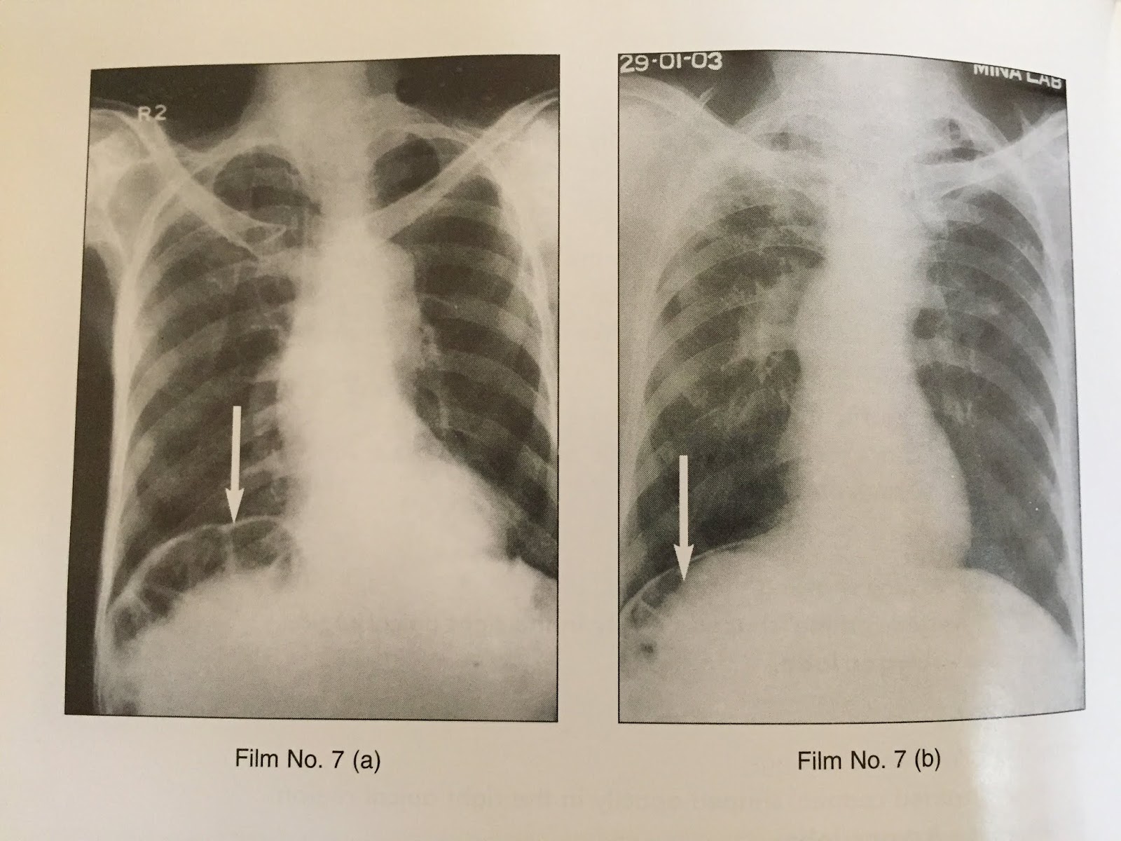 NORMAL VARIANT OF CHEST XRAY