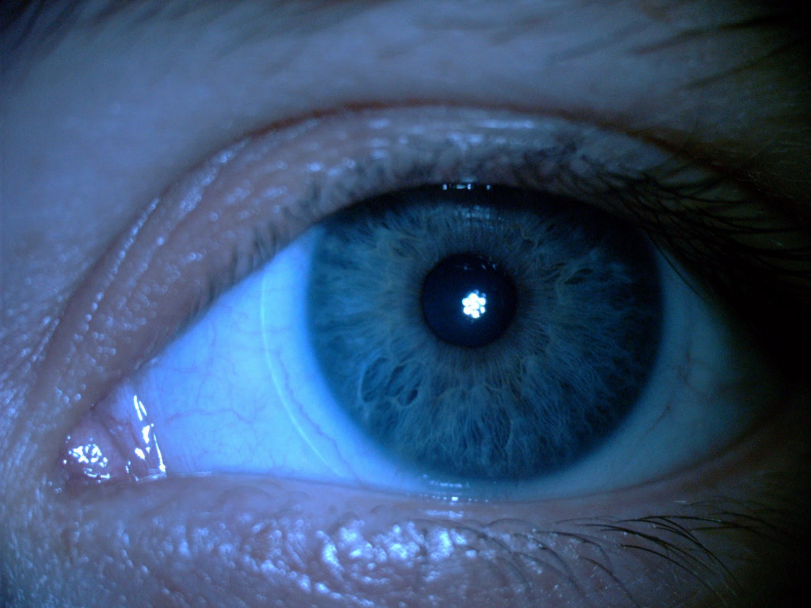 Vernon's Vision: CORNEA AND CONTACT LENS PICTURES