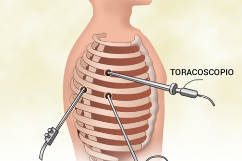 MUNDO ENFERMEDADES: DIAGNÓSTICO DERRAME PLEURAL
