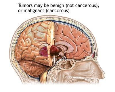 Cancer Treatment: brain tumor symptoms in men