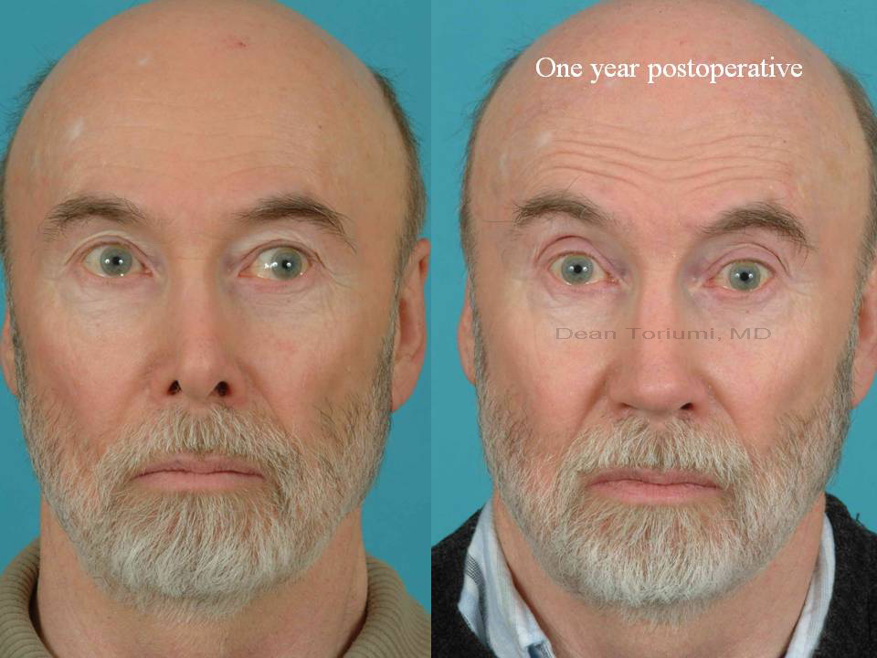 Dr. Dean Toriumi Reviews: Dean Toriumi Reviews: Secondary rhinoplasty ...