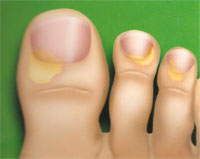 Podóloga Patrícia Costa: O que é Paroníquia???