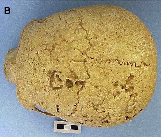Sciency Thoughts: Evidence of Leprosy in from an early Anglo Saxon ...
