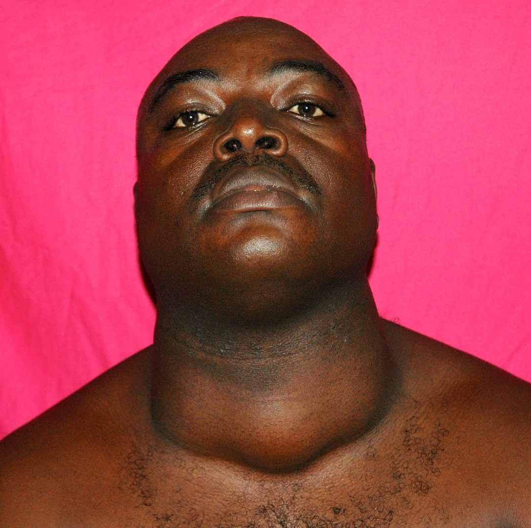 Earthwide Surgical Foundation: GOITERS