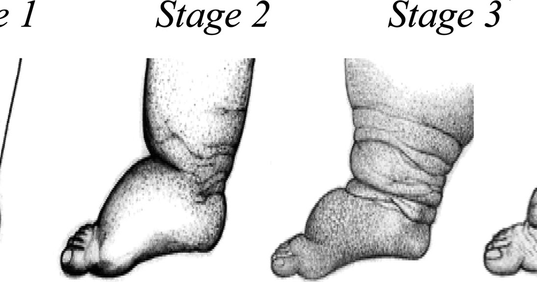 Obat Alami Kaki Gajah (Filariasis) 100% Herbal ~ Jeje Punya
