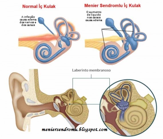 MENİER SENDROMU: Kulak Hastalıkları Resimleri