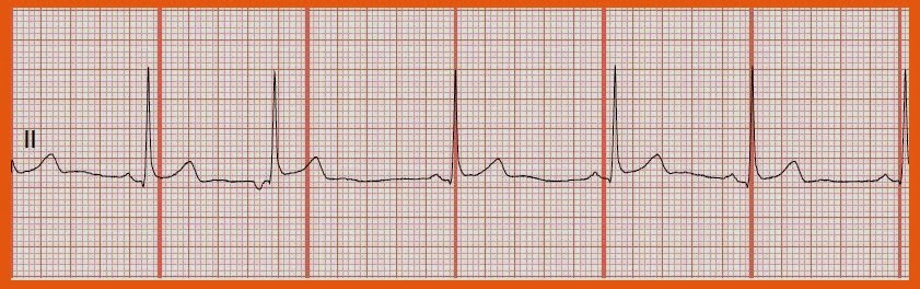 EKG Rhythm Strip Quiz 207