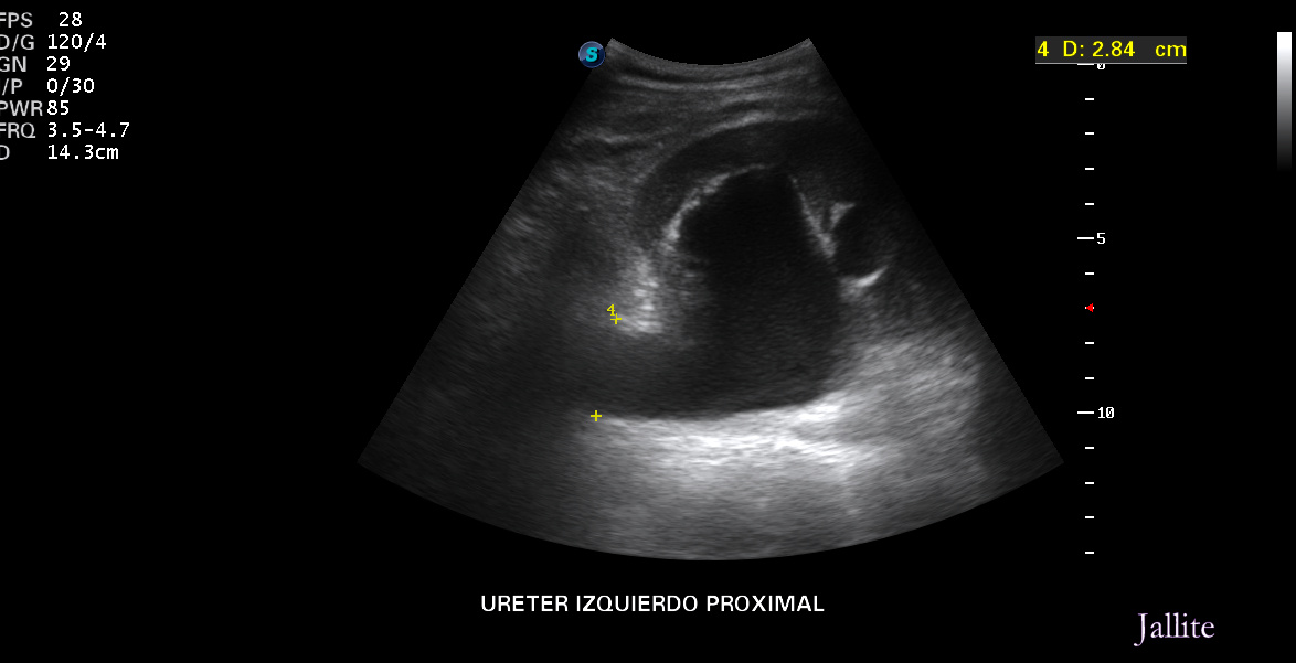 Absceso & Hidronefrosis Renal