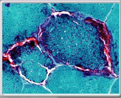 Síndrome merrf; Doença de Fukuhara; Epilepsia Mioclônica com Fibras ...