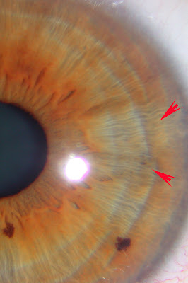 Modern & Multidimensional Iridology: Stress Axis, Radii solaris ...