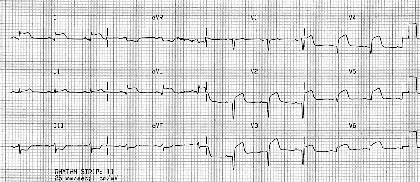 Lateral ST Elevation Myocardial Infarction | INA - ECG