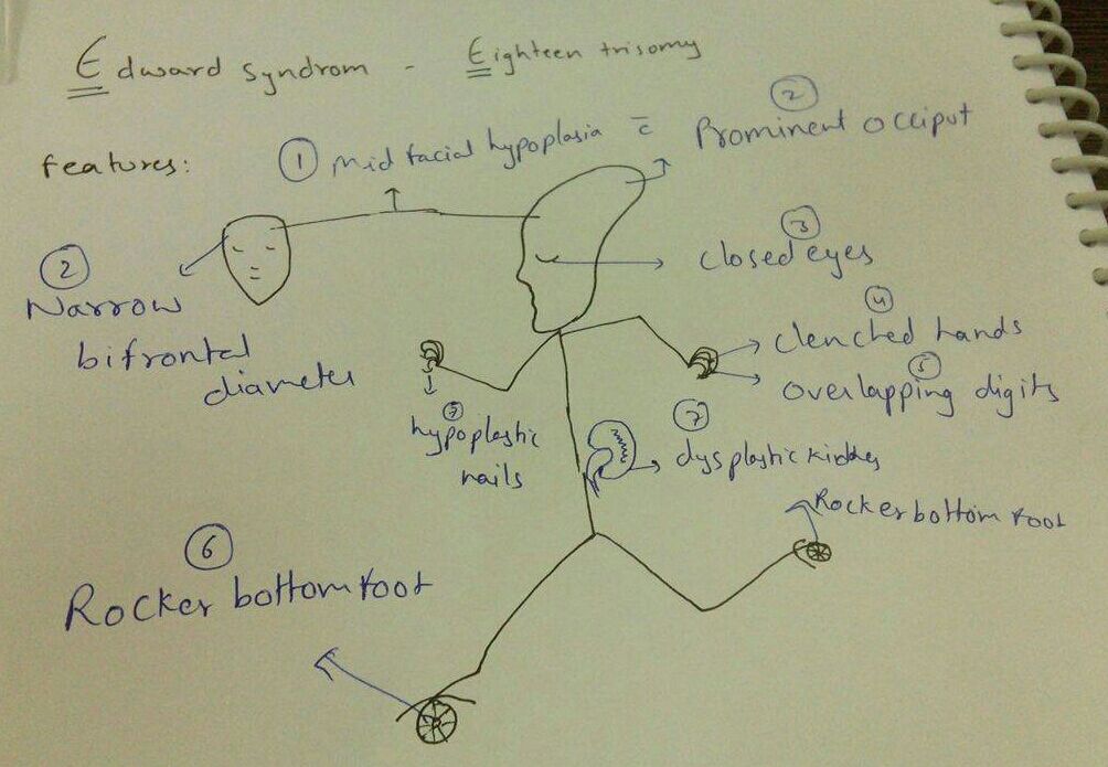Medicowesome: Edward syndrome notes and mnemonic