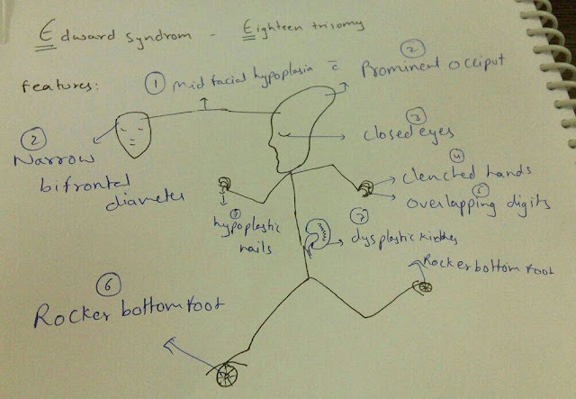 Medicowesome: Edward syndrome notes and mnemonic