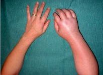 Osteoporose - Handeln bevor der Knochen bricht: Morbus Sudeck