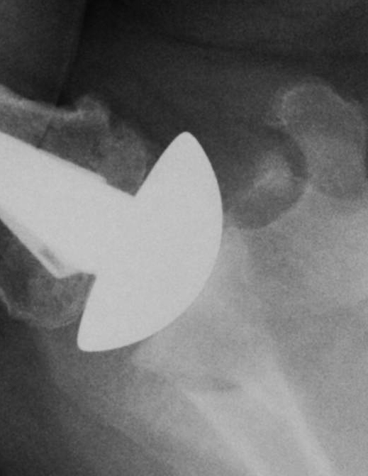 UW Shoulder and Elbow Academy: Ream and run, returning to have the ...