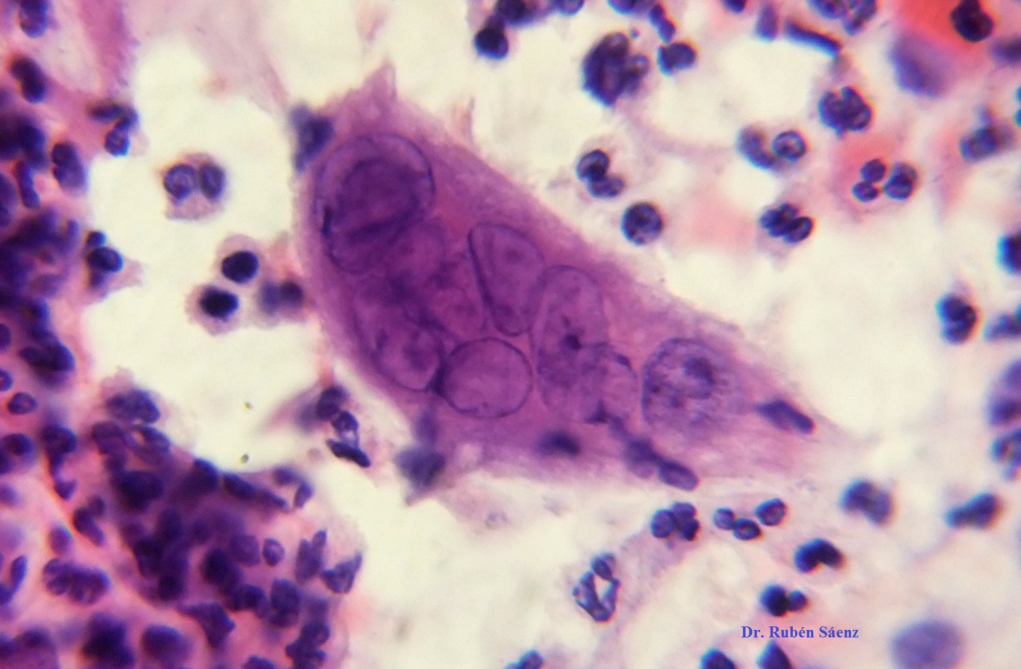 THE PERUVIAN CYTOPATHOLOGY CORNER: CITOLOGÍA CERVICAL: CAMBIOS POR HSV