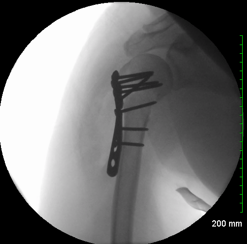 Shoulder and Elbow Surgery: Corrective osteotomy for surgical neck ...