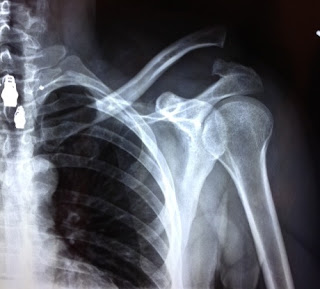 Fall and bump on shoulder = it's a shoulder separation!